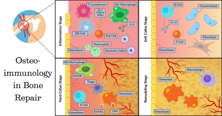 Immune System and Bone Healing: Understanding the Connection ...